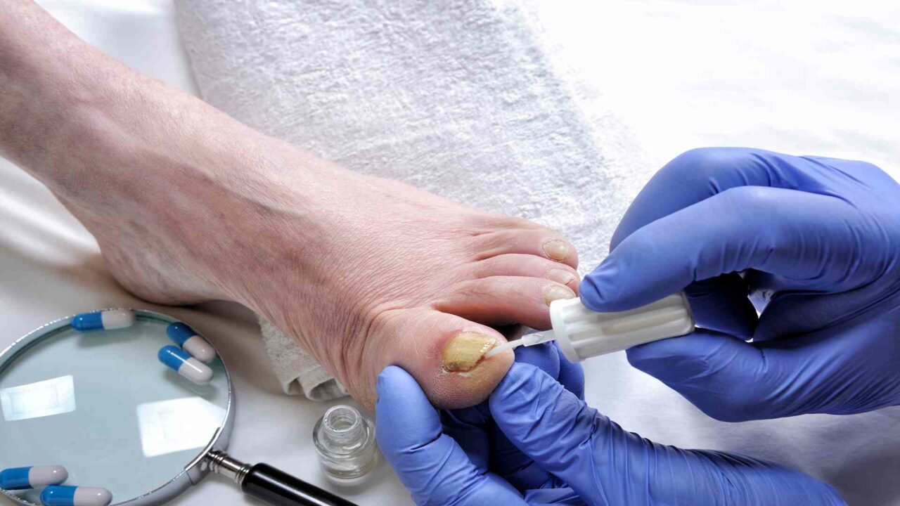 Onychomycosis Treatment: Information About Tavaborole